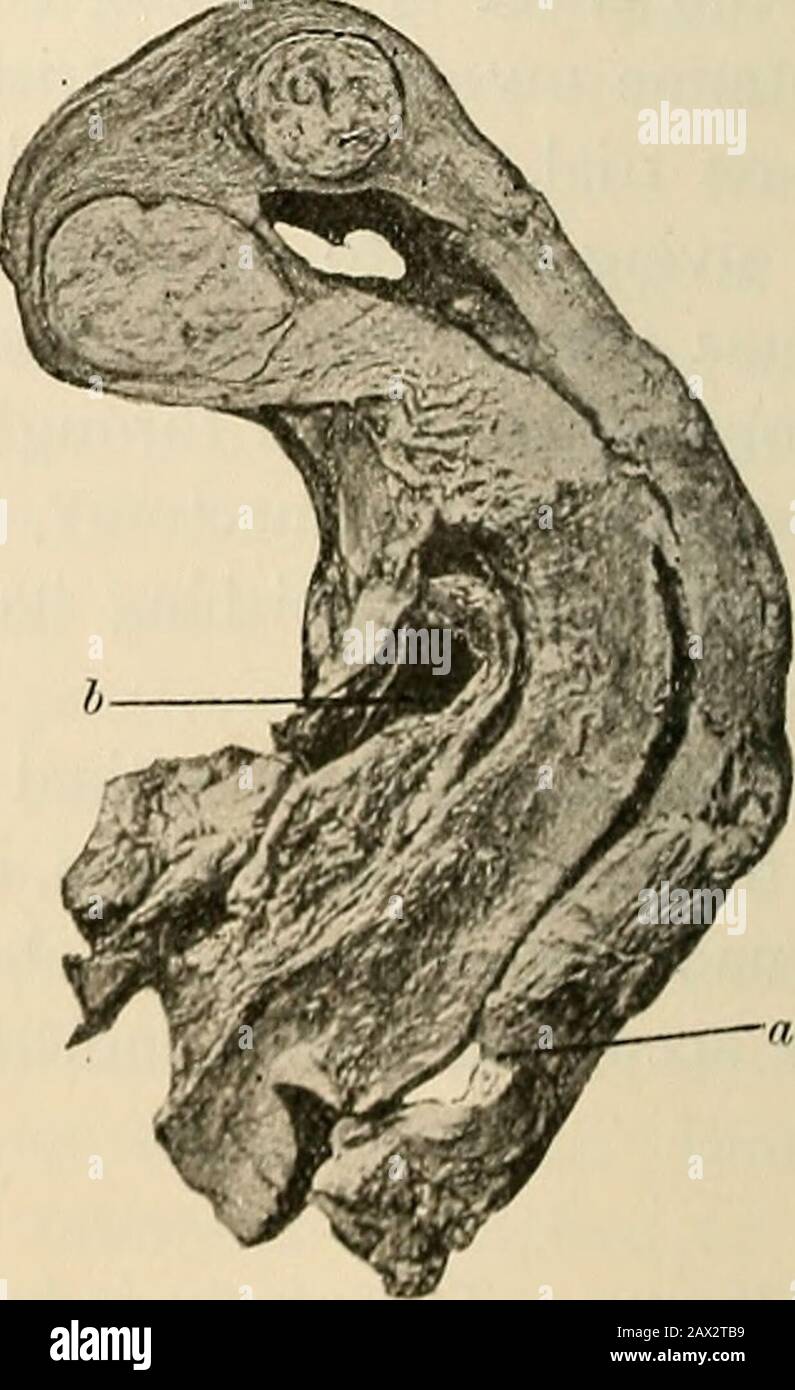Die Pathologie und chirurgische Behandlung von Tumoren . Abb. 344.-Zwei ...