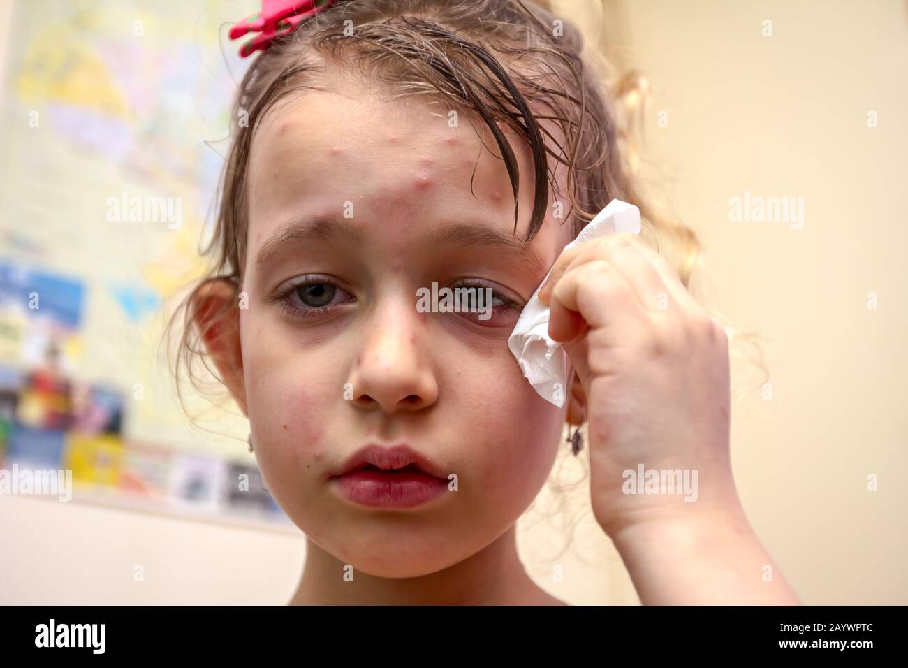 Pocken Pocken Krankheit Stockfotos und -bilder Kaufen - Alamy