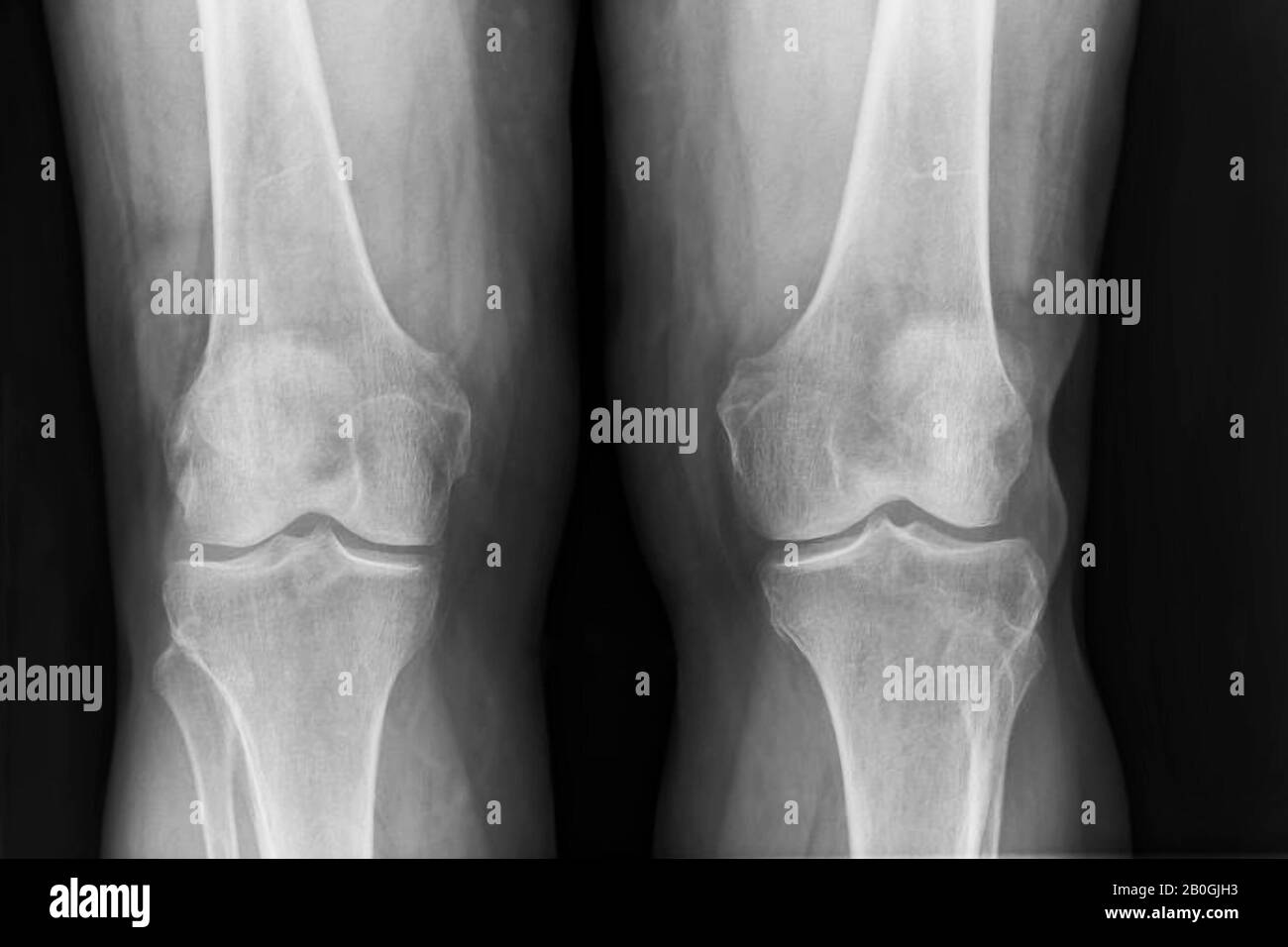 Knochen tibia femur -Fotos und -Bildmaterial in hoher Auflösung – Alamy