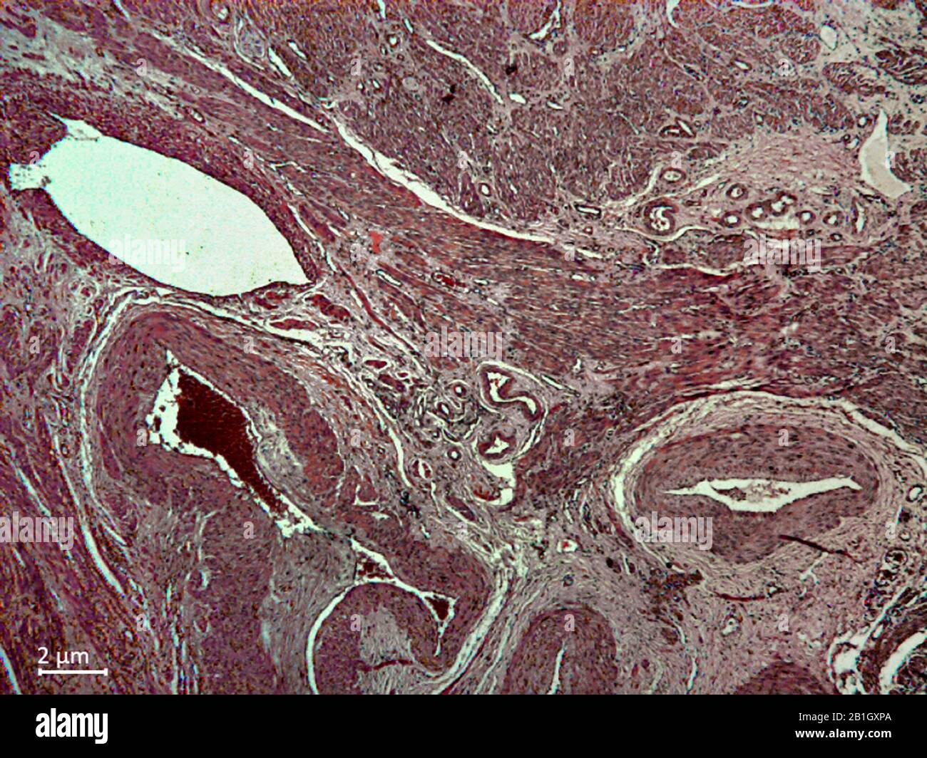 Histologischer Gewebeschnitt einer Gebärmutter mit Myom, 200-fach ...