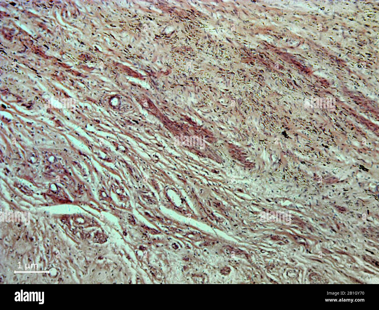 Histologischer Gewebeschnitt einer Gebärmutter mit Fibroadenom, 500x ...