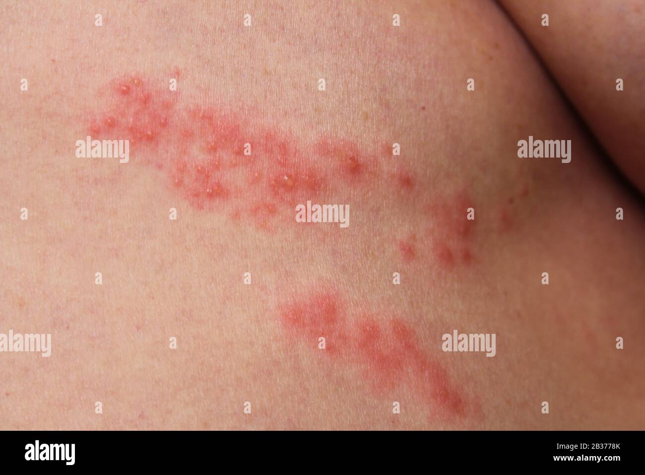 Herpes Zoster Stockfotos und -bilder Kaufen - Alamy
