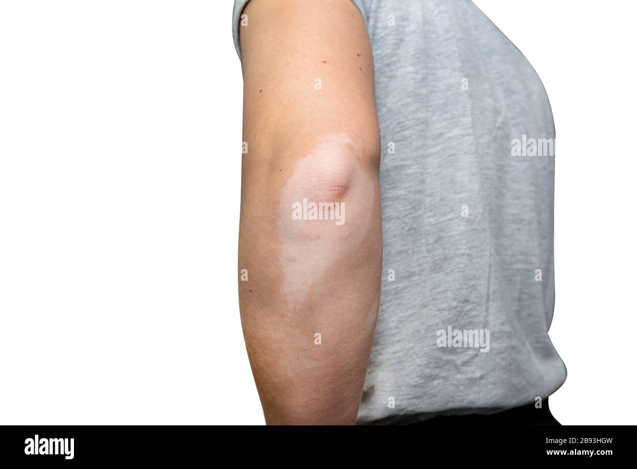 Weiße flecken an den schultern -Fotos und -Bildmaterial in hoher ...