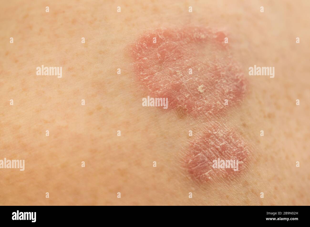 Psoriasis Haut. Zwei Psoriasplaketten auf heller Haut. Psoriasis ist ...