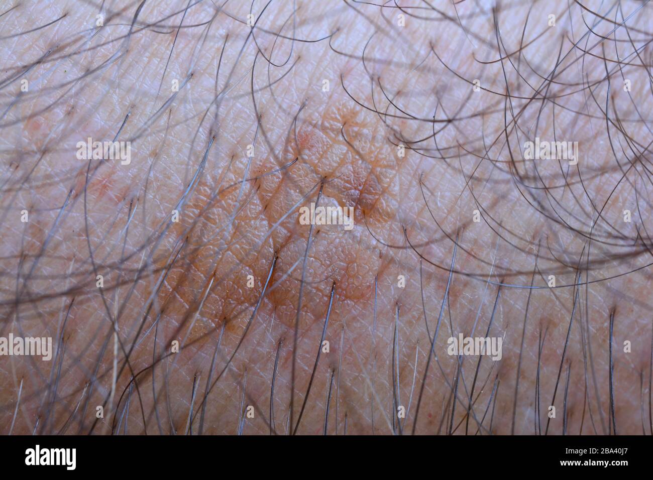 Gutartiger hauttumor -Fotos und -Bildmaterial in hoher Auflösung – Alamy