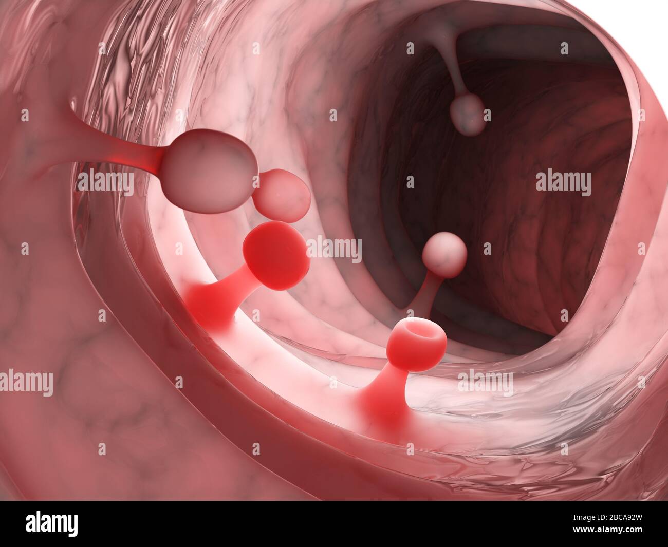 Polypen des dickdarms -Fotos und -Bildmaterial in hoher Auflösung – Alamy