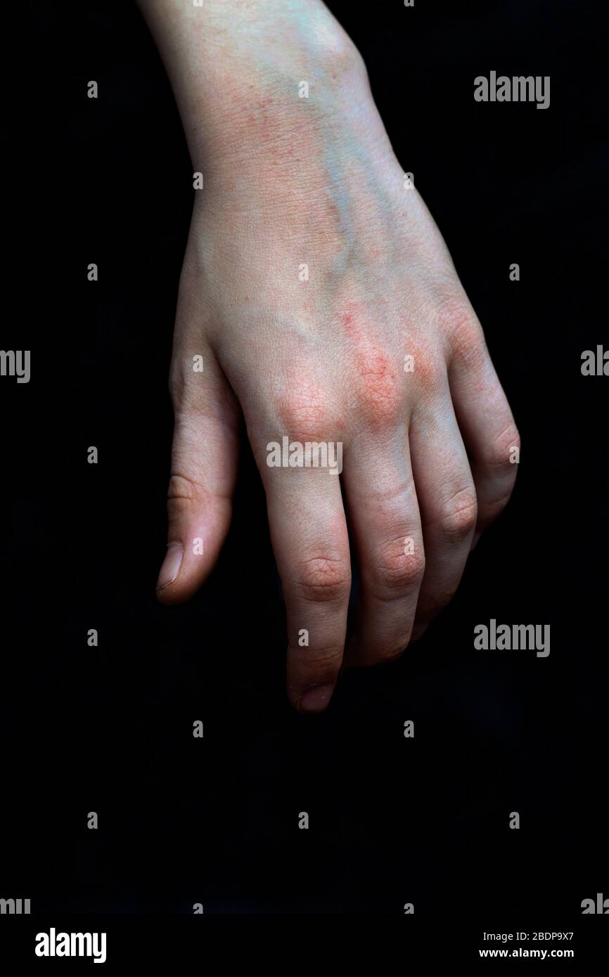 Limp hand -Fotos und -Bildmaterial in hoher Auflösung – Alamy