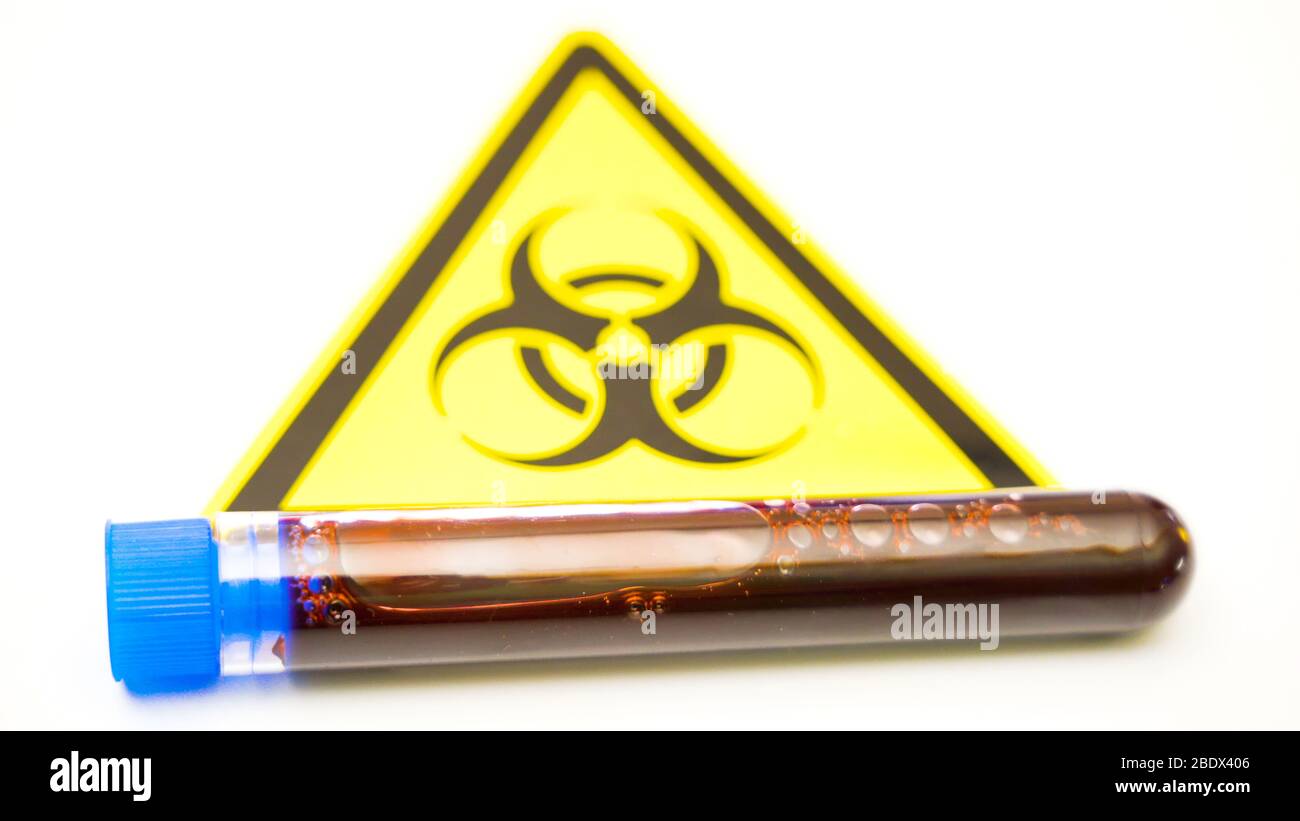 Das gelbe Warnschild mit dem Blutprobenkit auf dem Tisch im Labor ...