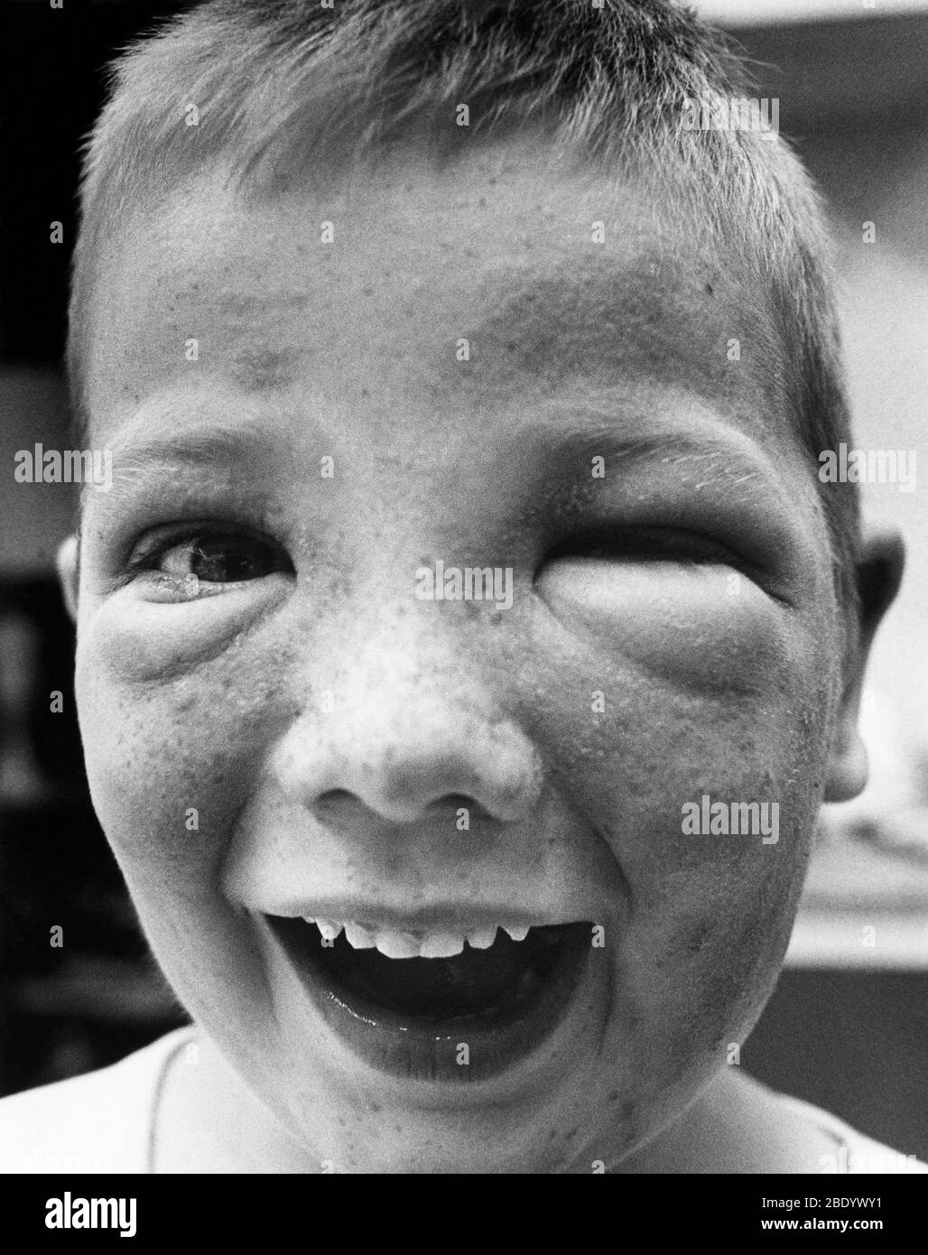 Poison Ivy Rash Stockfotos und -bilder Kaufen - Alamy