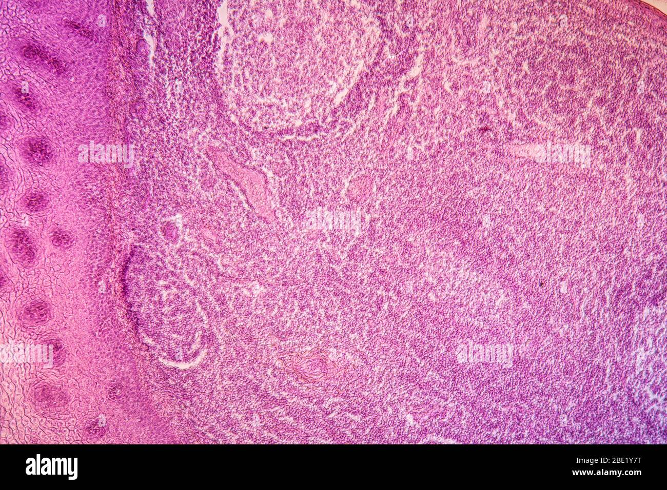 Tonsils tonsillitis -Fotos und -Bildmaterial in hoher Auflösung - Seite ...