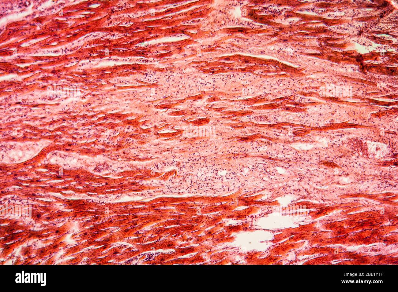 Tissue cyst -Fotos und -Bildmaterial in hoher Auflösung – Alamy