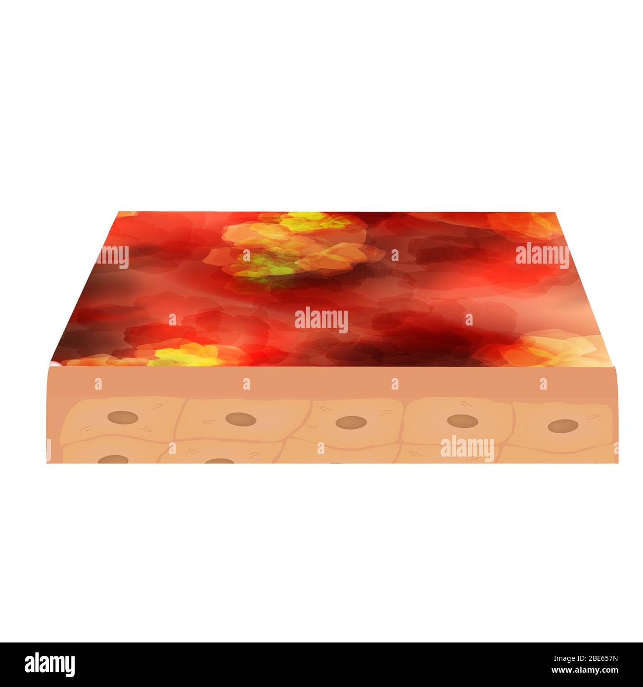 Zyste Akne. furonheim Acne auf der Haut Zysten und Pickel ...