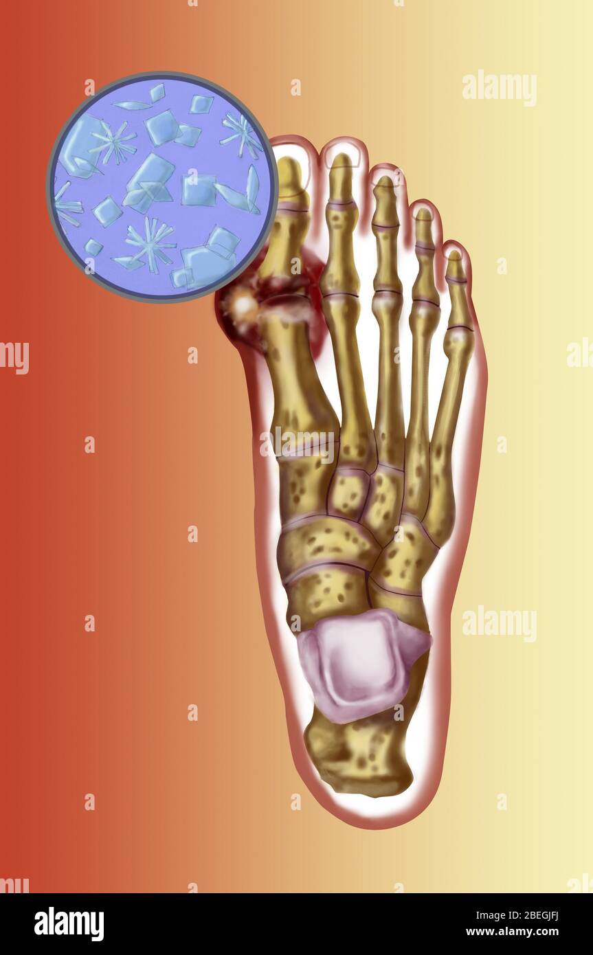 Gicht tophus -Fotos und -Bildmaterial in hoher Auflösung – Alamy