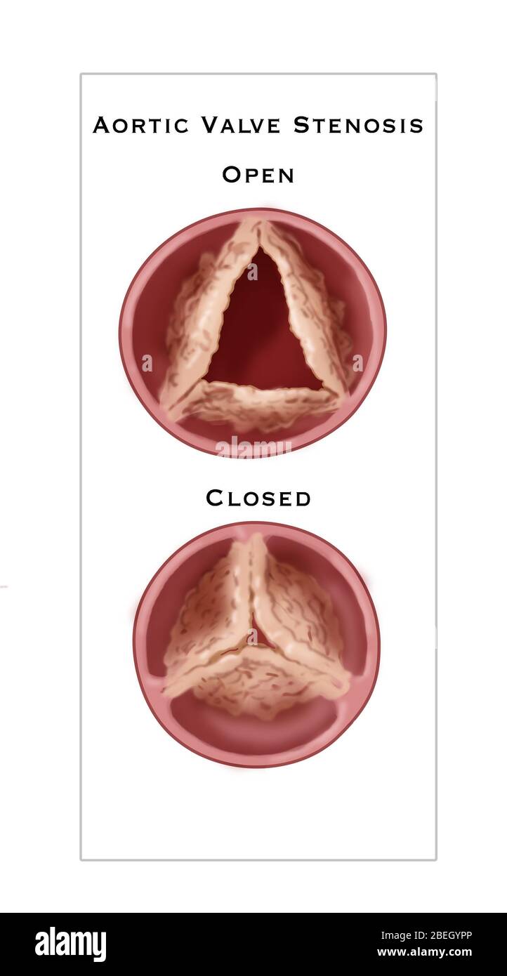 Aortic valve stenosis -Fotos und -Bildmaterial in hoher Auflösung – Alamy