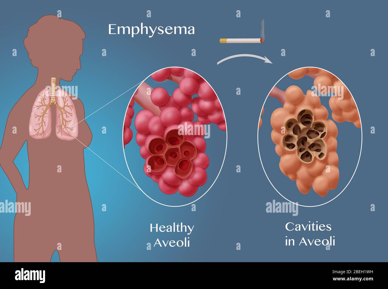 Emphysema lung -Fotos und -Bildmaterial in hoher Auflösung – Alamy