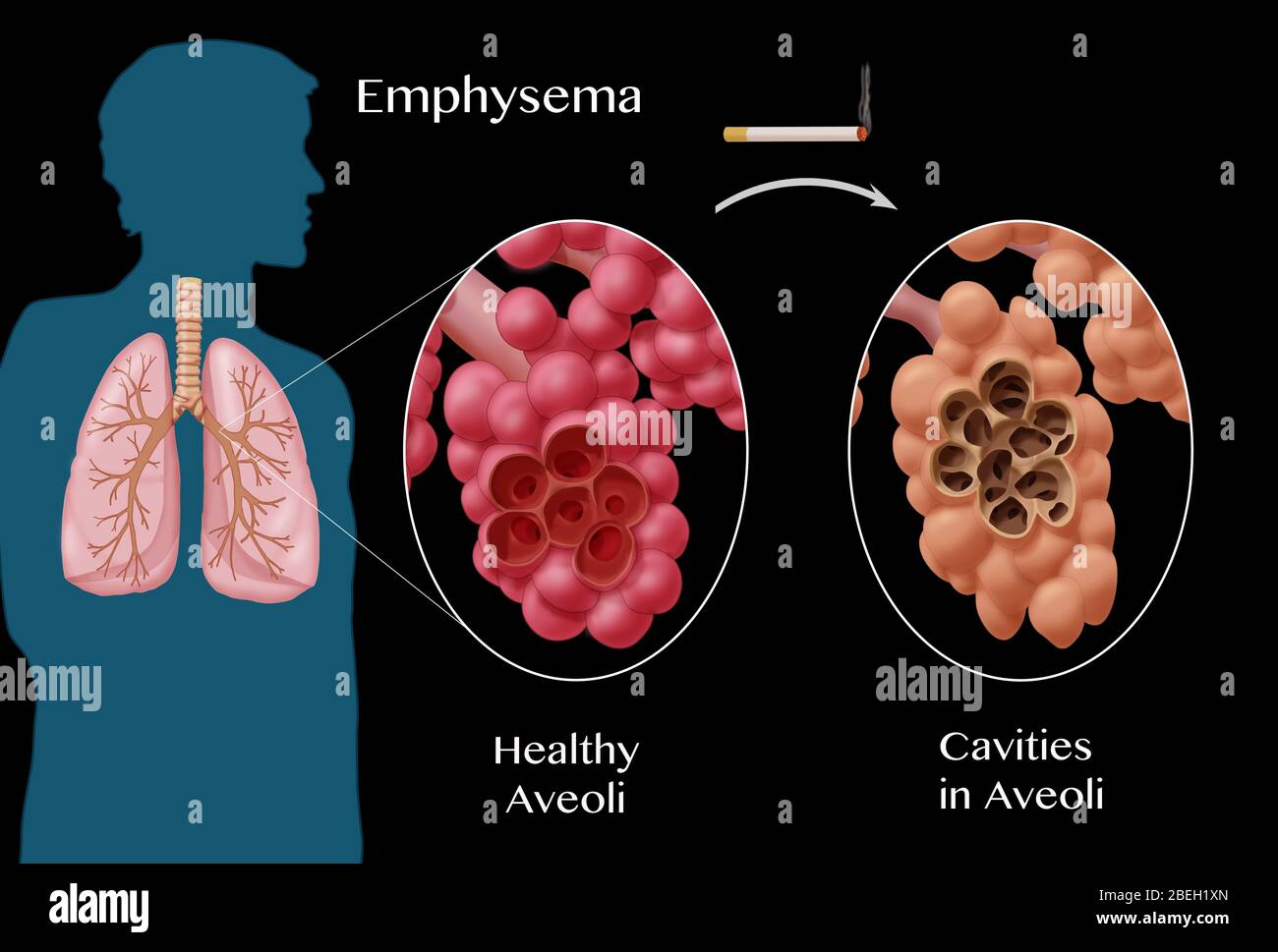 Healthy Lung Alveoli Stockfotos und -bilder Kaufen - Alamy