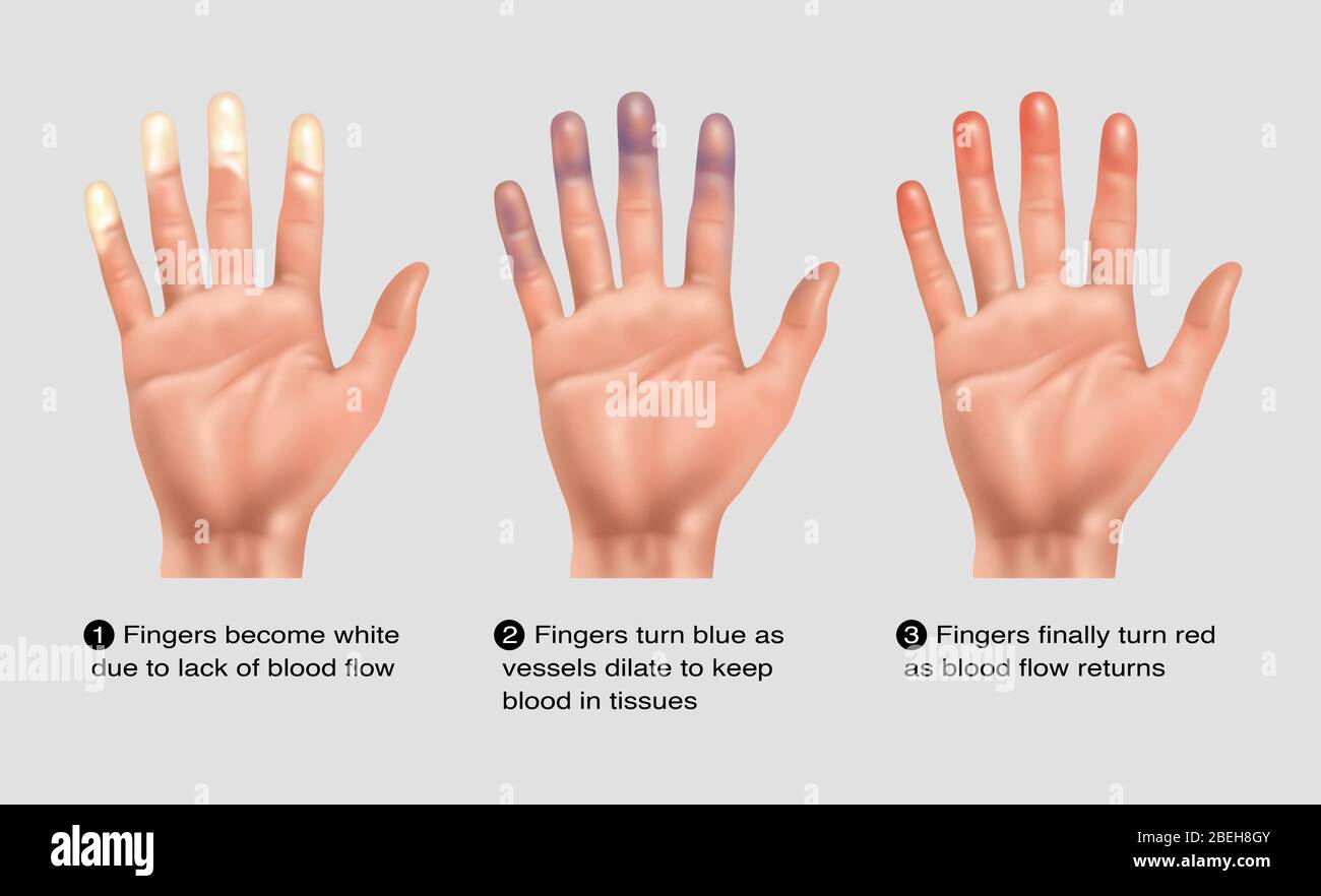 Raynauds phenomenon -Fotos und -Bildmaterial in hoher Auflösung – Alamy
