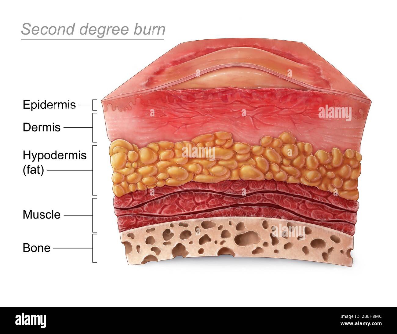 Verbrennung Zweiten Grades Stockfotos und -bilder Kaufen - Alamy