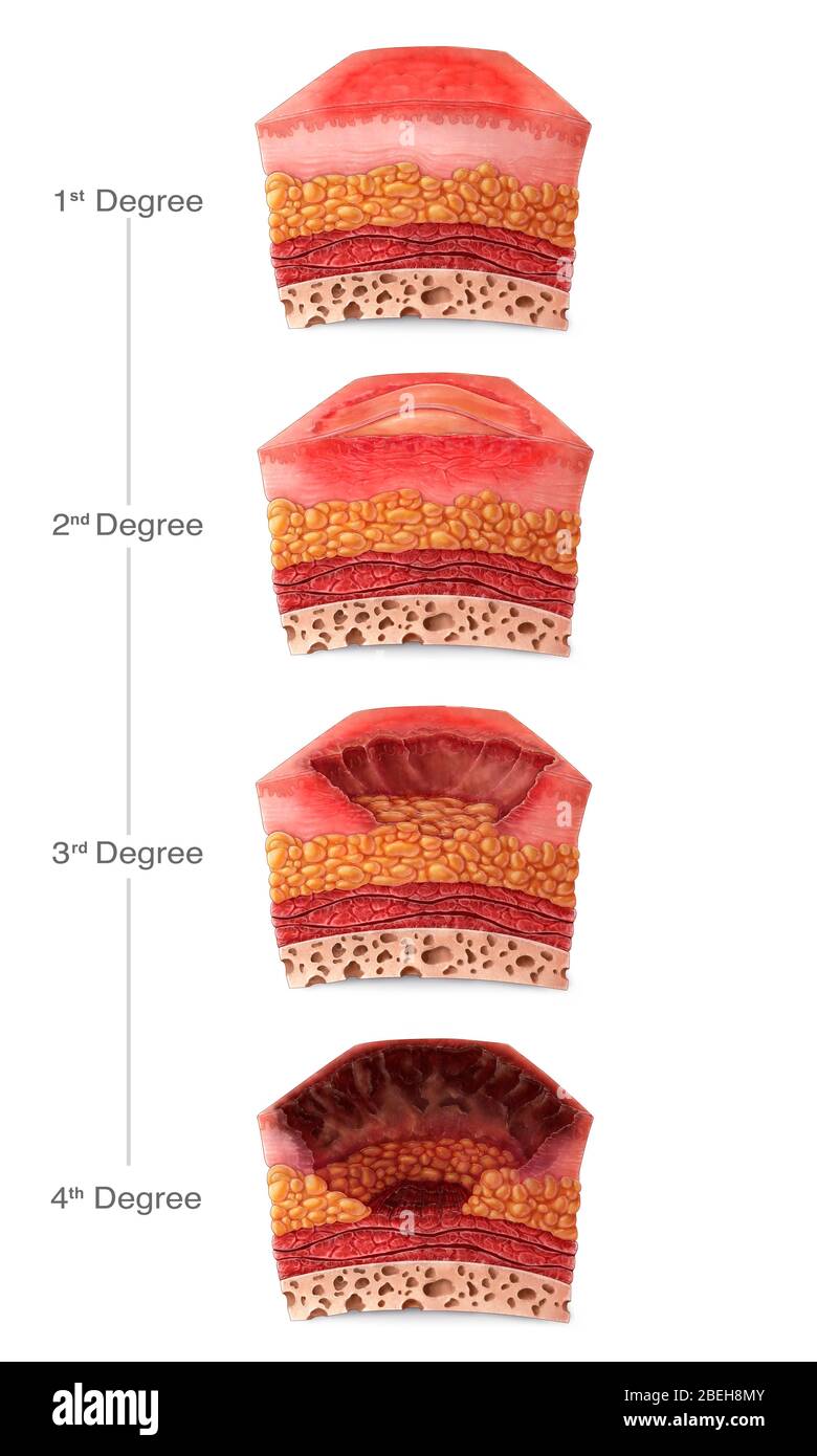 Verbrennung zweiten grades -Fotos und -Bildmaterial in hoher Auflösung ...