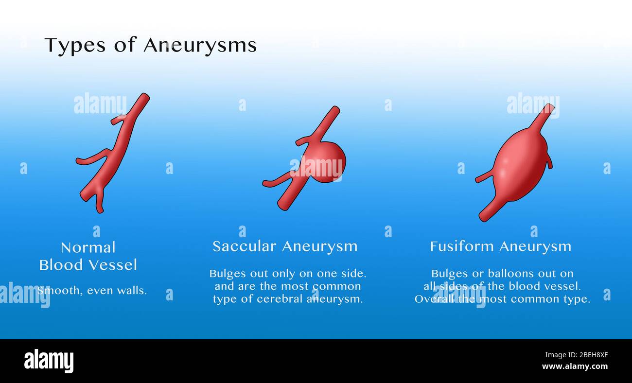 Tipos de aneurisma cerebral -Fotos und -Bildmaterial in hoher Auflösung ...