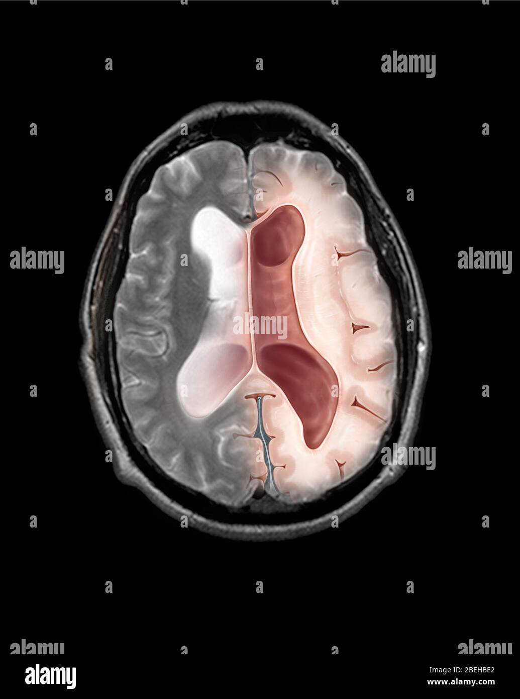 Mri of hydrocephalus -Fotos und -Bildmaterial in hoher Auflösung – Alamy