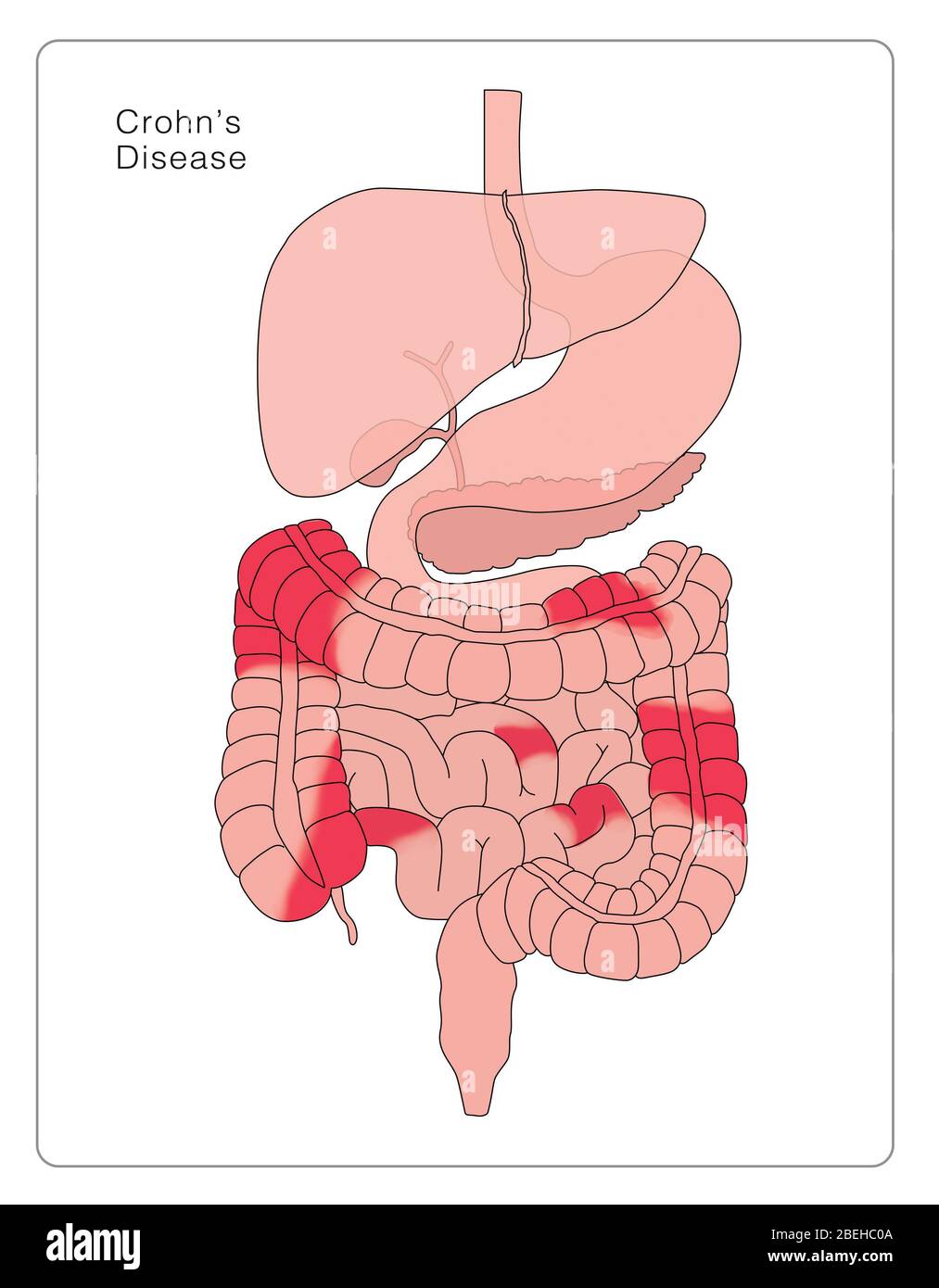 Crohn's disease colon -Fotos und -Bildmaterial in hoher Auflösung – Alamy