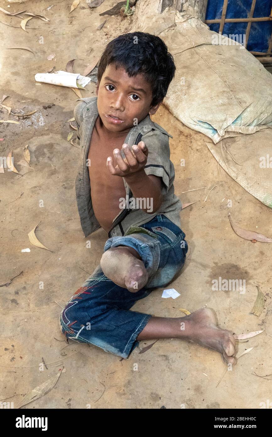 Amputation Amputated Stockfotos und -bilder Kaufen - Seite 3 - Alamy