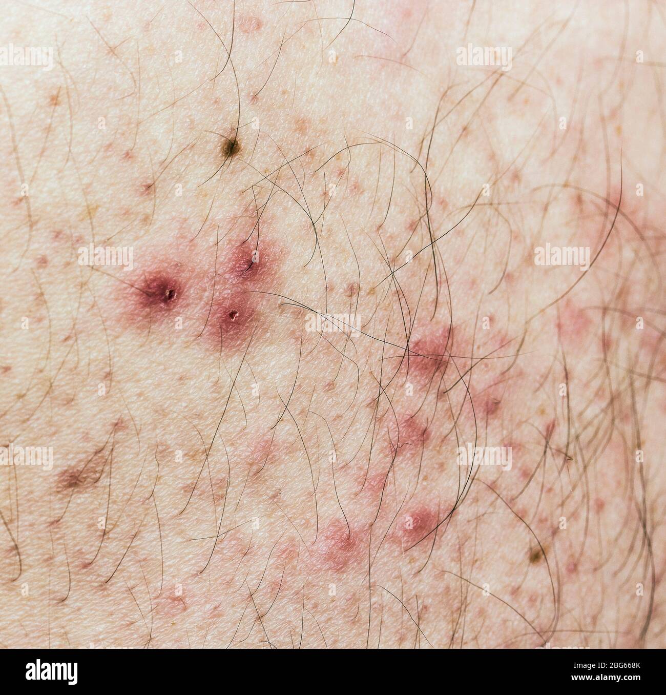 Frühe Stadien des Ausschlags des Varicella-Zoster-Virus bei einem ...