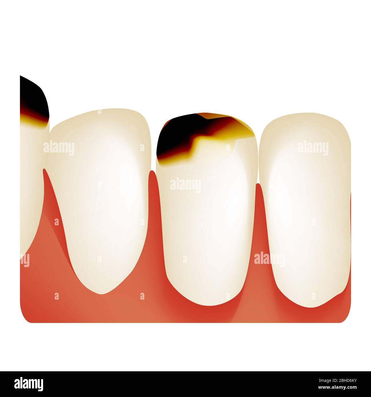 Karies. Karies. Karies. Karies-Infografiken. Vektorgrafik auf ...