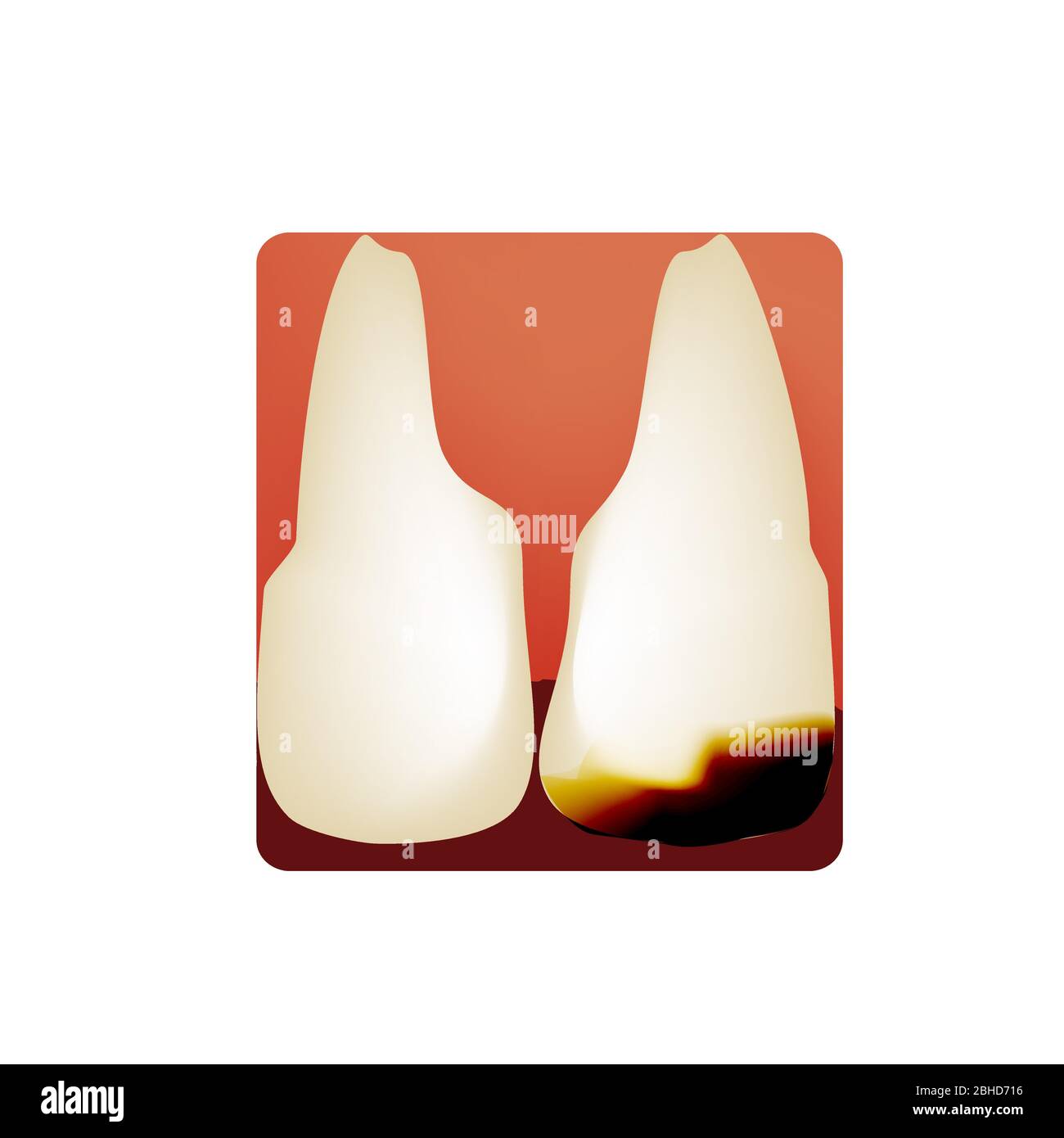 Karies. Karies. Karies. Karies-Infografiken. Vektorgrafik auf ...