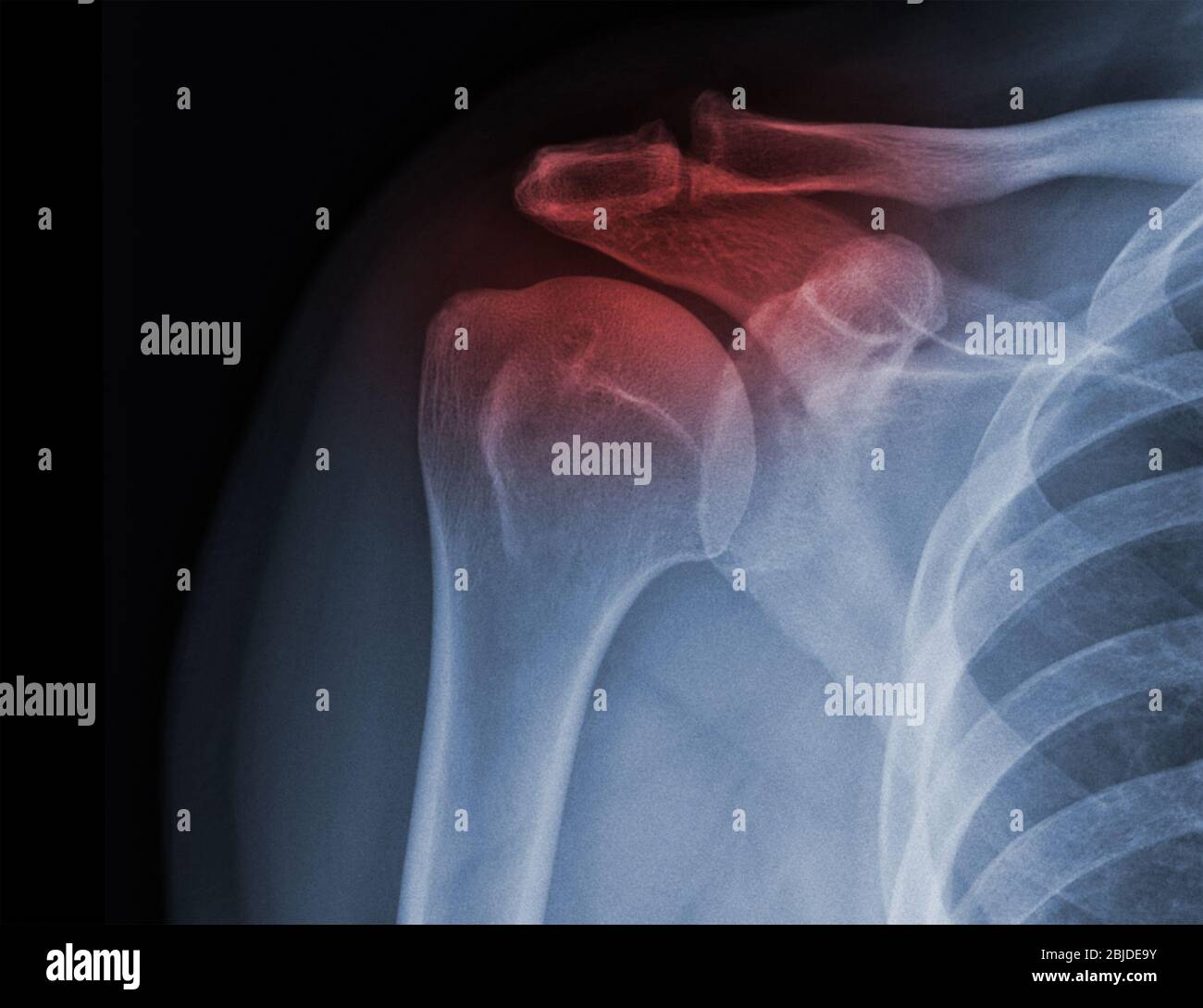 Fractured Humerus Stockfotos und -bilder Kaufen - Alamy