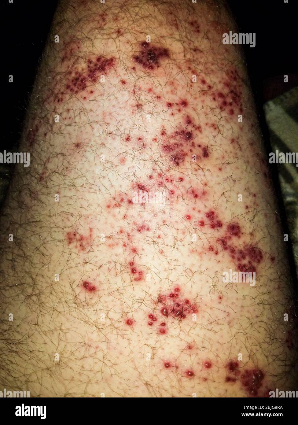 Herpes zoster impfung -Fotos und -Bildmaterial in hoher Auflösung – Alamy