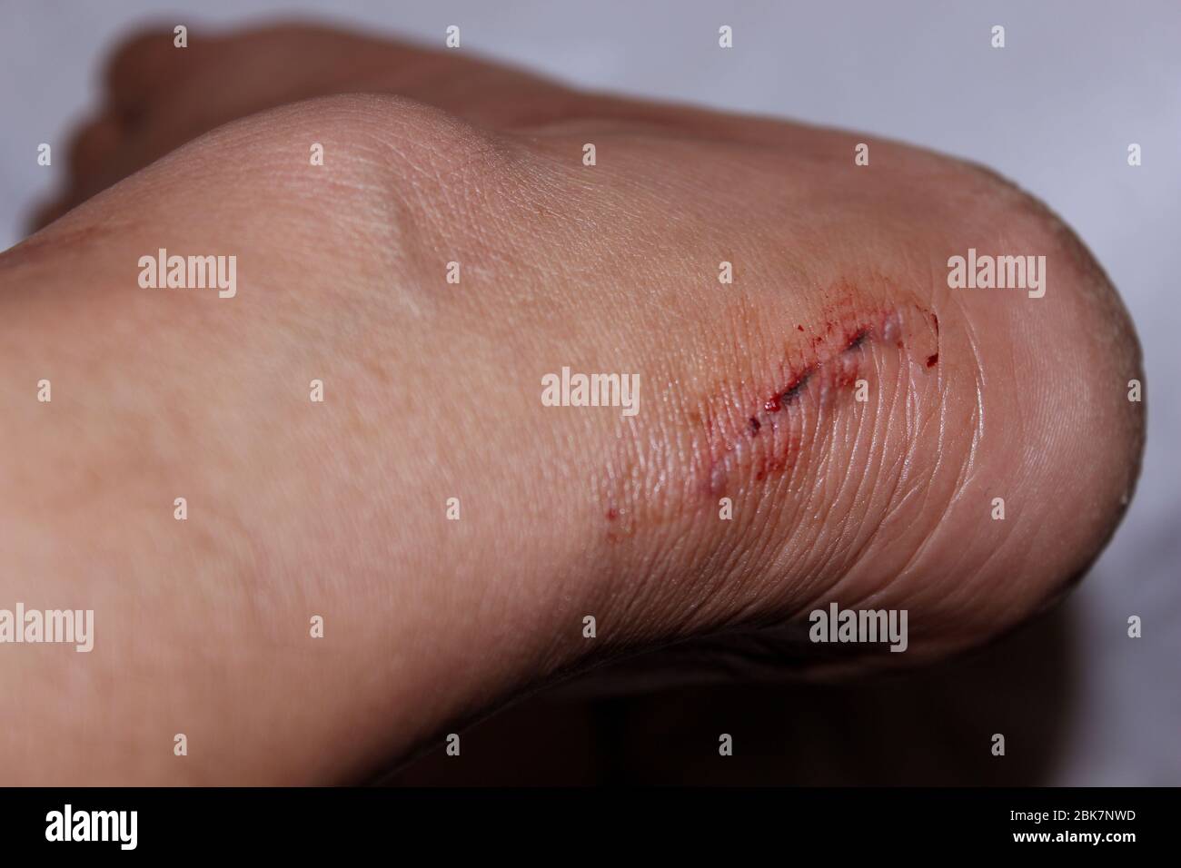 Offene fleischwunde -Fotos und -Bildmaterial in hoher Auflösung – Alamy