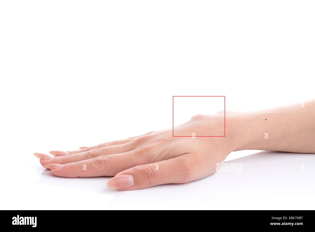 Ganglion cyst -Fotos und -Bildmaterial in hoher Auflösung – Alamy