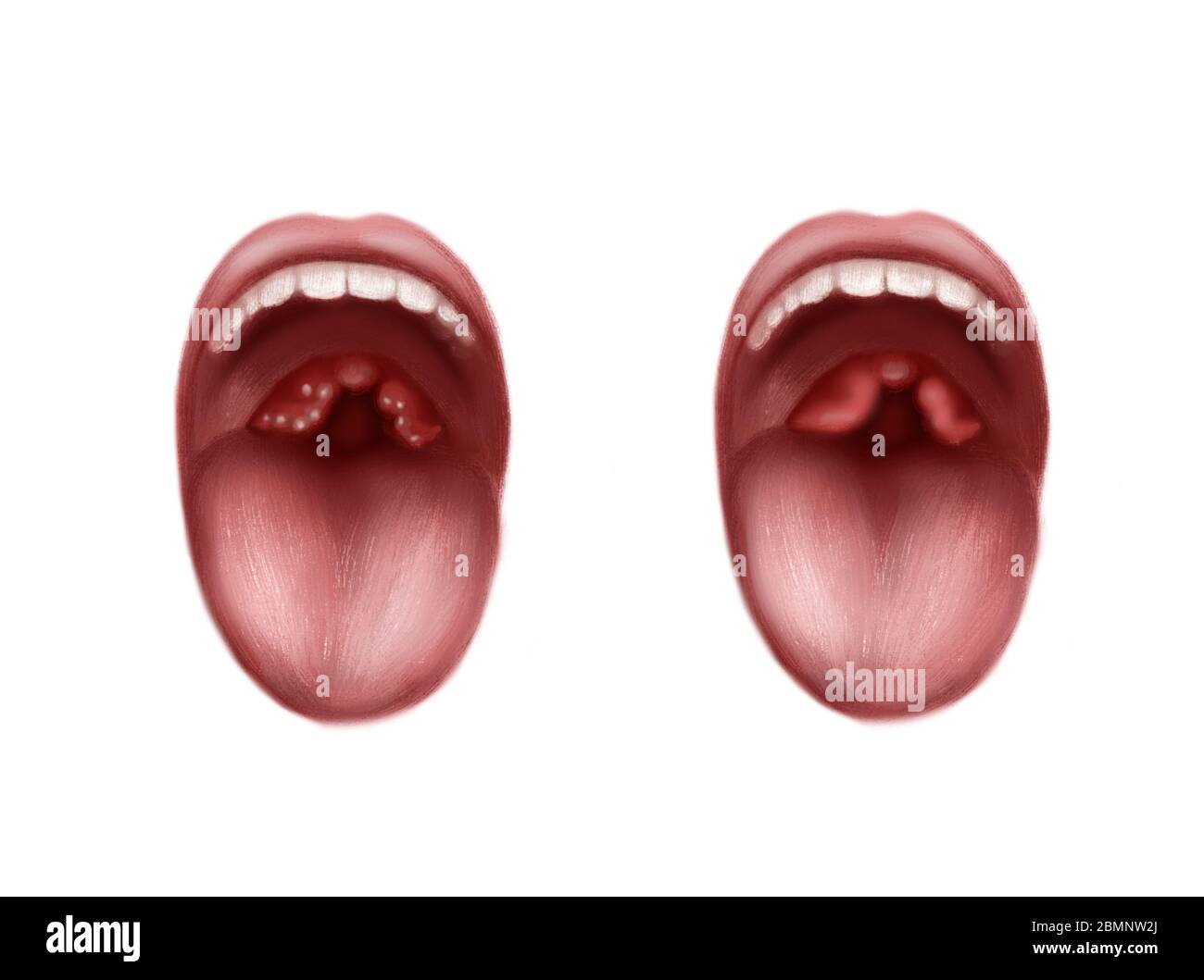 Akute atemwegserkrankungen -Fotos und -Bildmaterial in hoher Auflösung ...