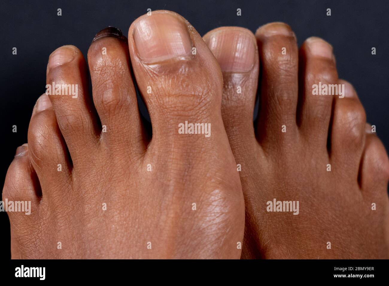 Hammer Zehe oder Klaue Zehe einer Frau aus gemischter Rasse vor ...