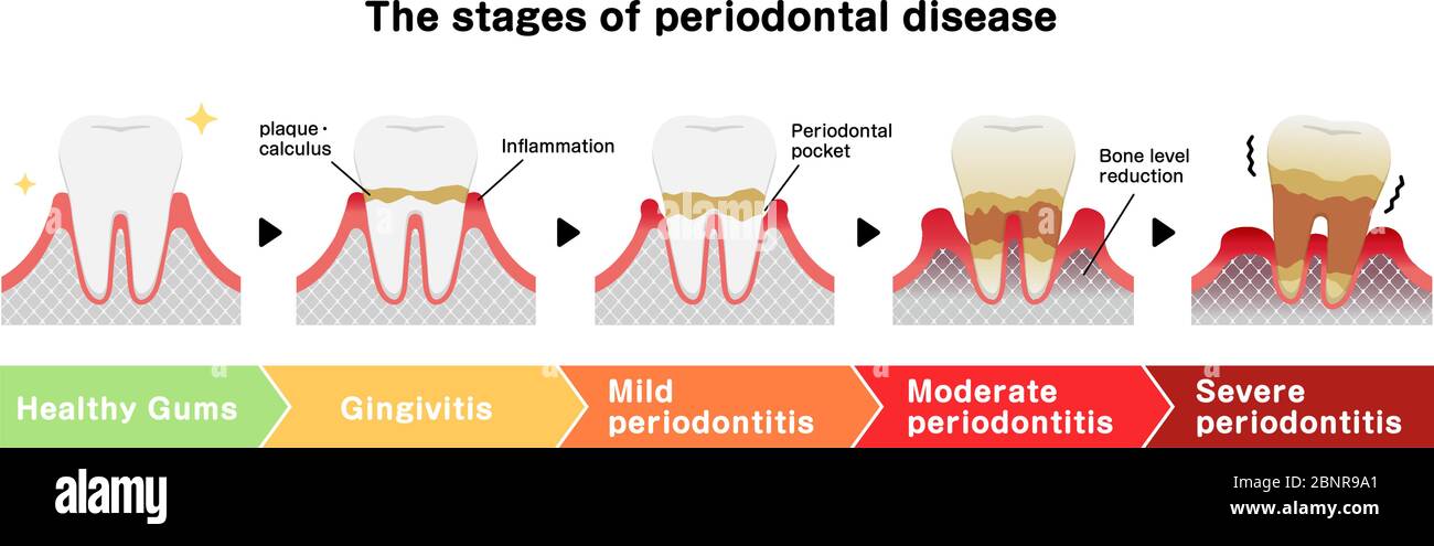 Die Stadien der Parodontitis Krankheit Vektor Illustration Stock ...
