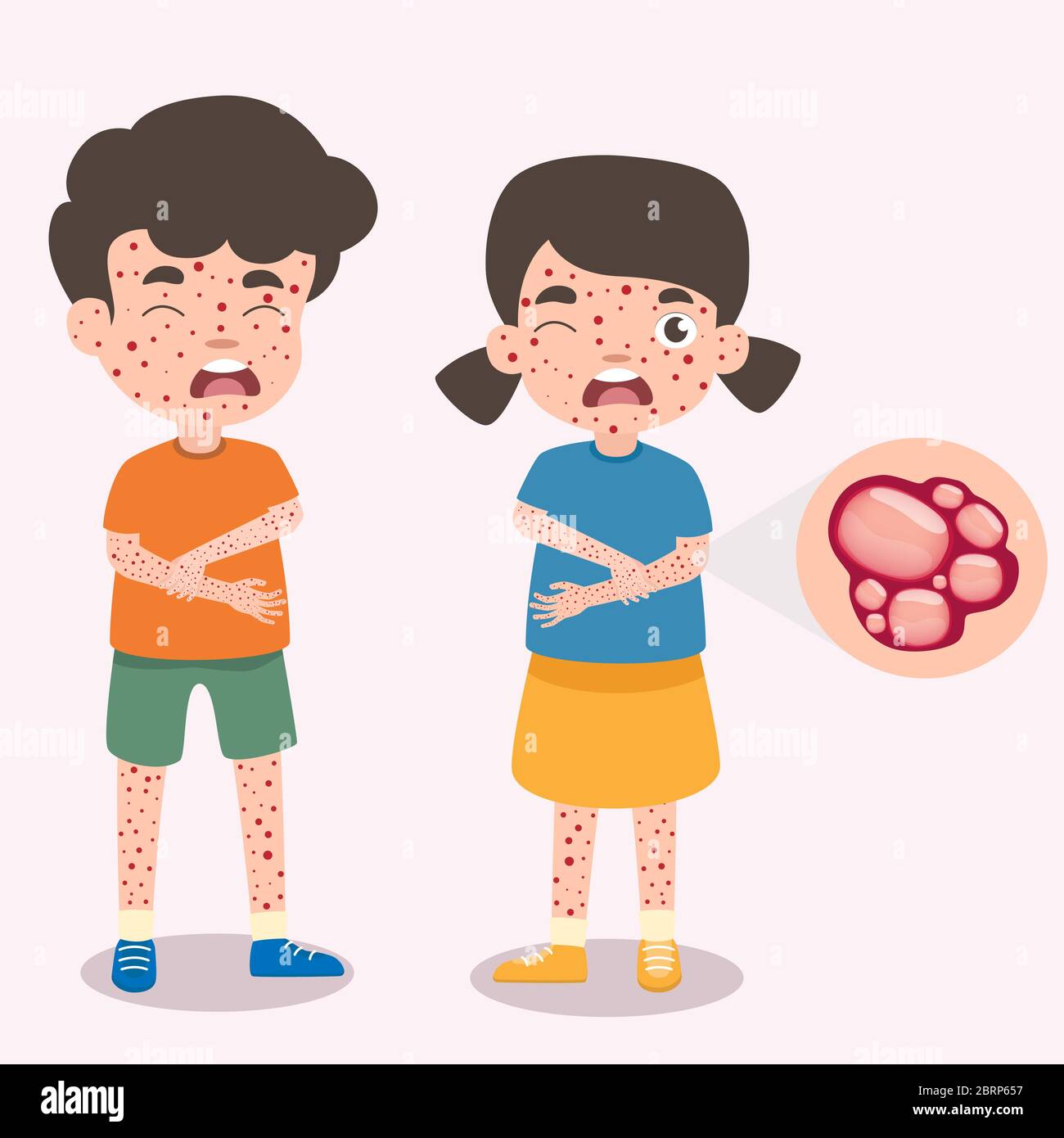 Kinder haben Windpocken Infografik, Poster Kinder Fieber und Windpocken ...