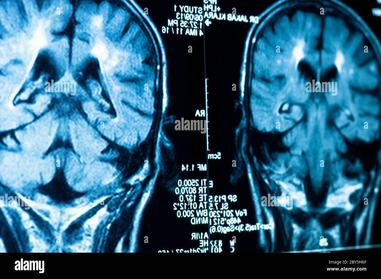 Ct des gehirns -Fotos und -Bildmaterial in hoher Auflösung – Alamy