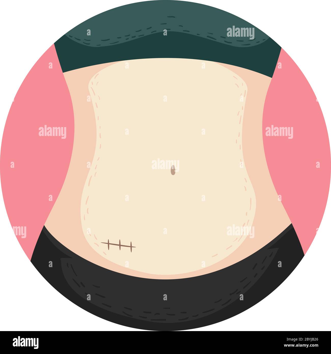 Abbildung einer Frau zeigt Bauch mit Stichen aus Appendektomie ...