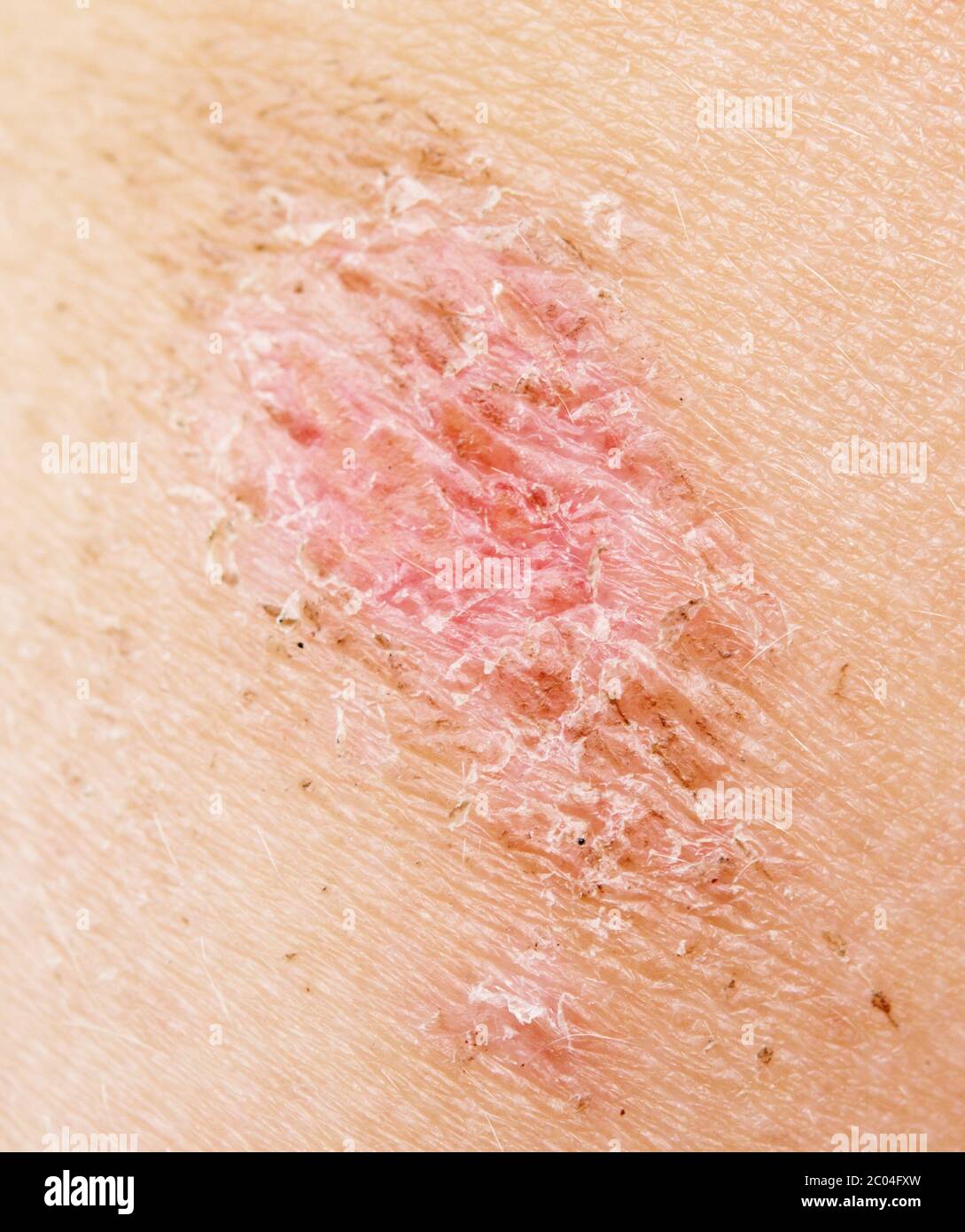 Zerrissene wunde -Fotos und -Bildmaterial in hoher Auflösung – Alamy