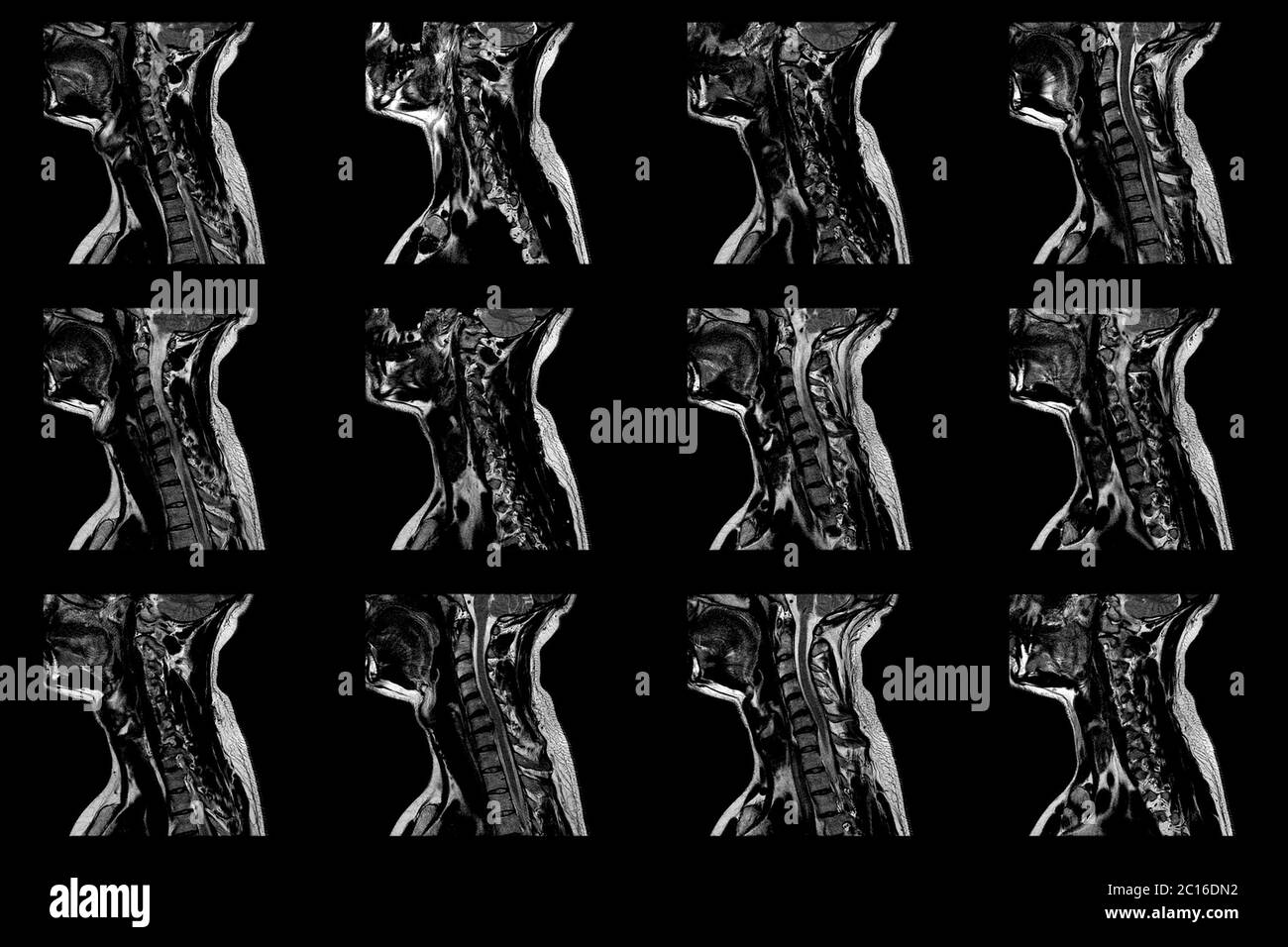 Sagittal mri -Fotos und -Bildmaterial in hoher Auflösung – Alamy