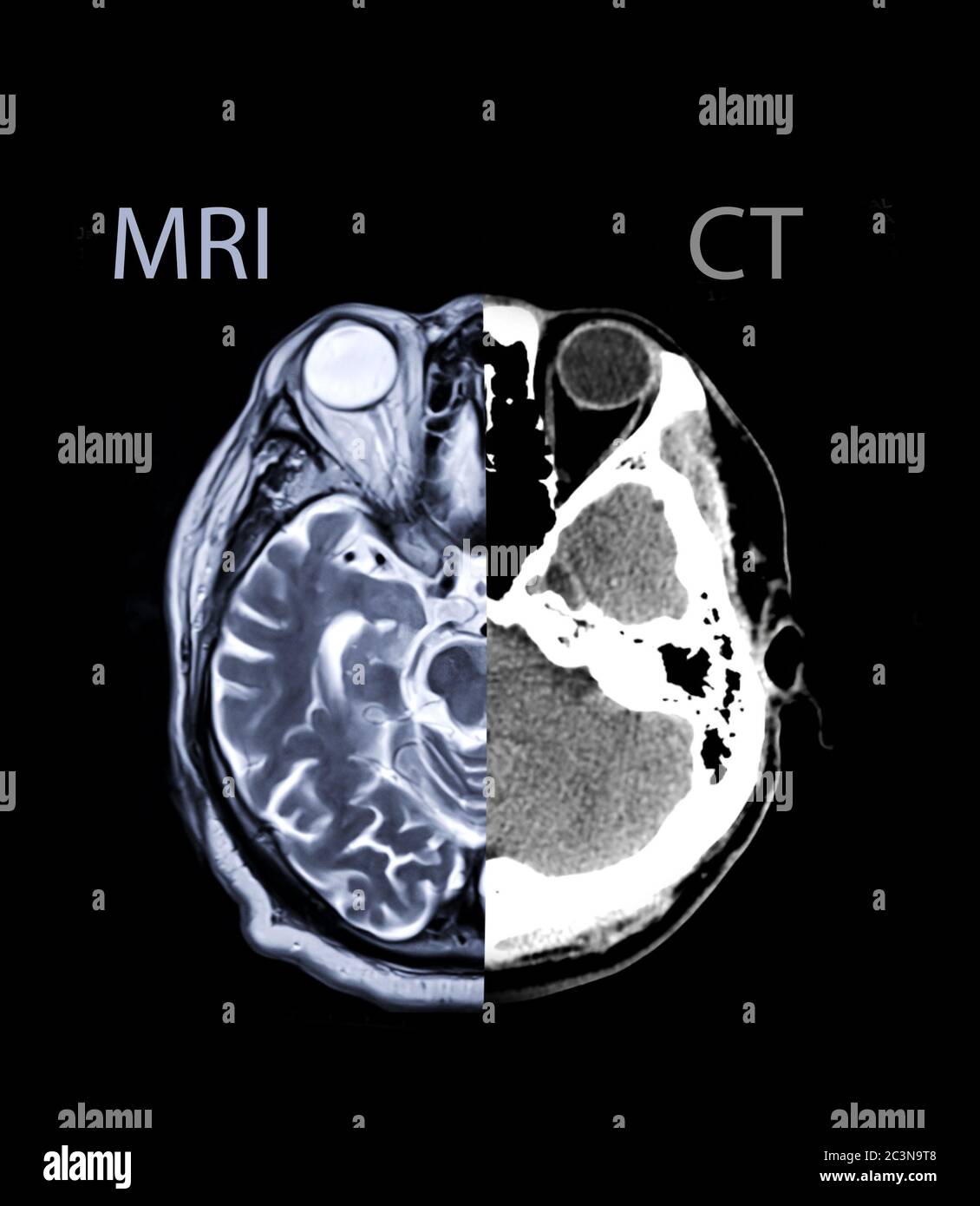 Vergleichen und Mischen von MRT-Gehirn Axial T2 und CT-Gehirn axialen ...