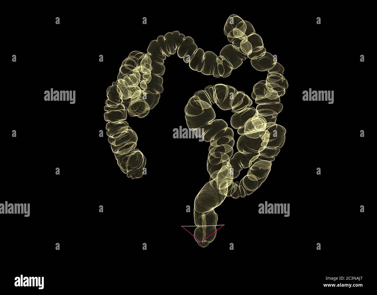 Abdominal ct scan abdomen -Fotos und -Bildmaterial in hoher Auflösung ...