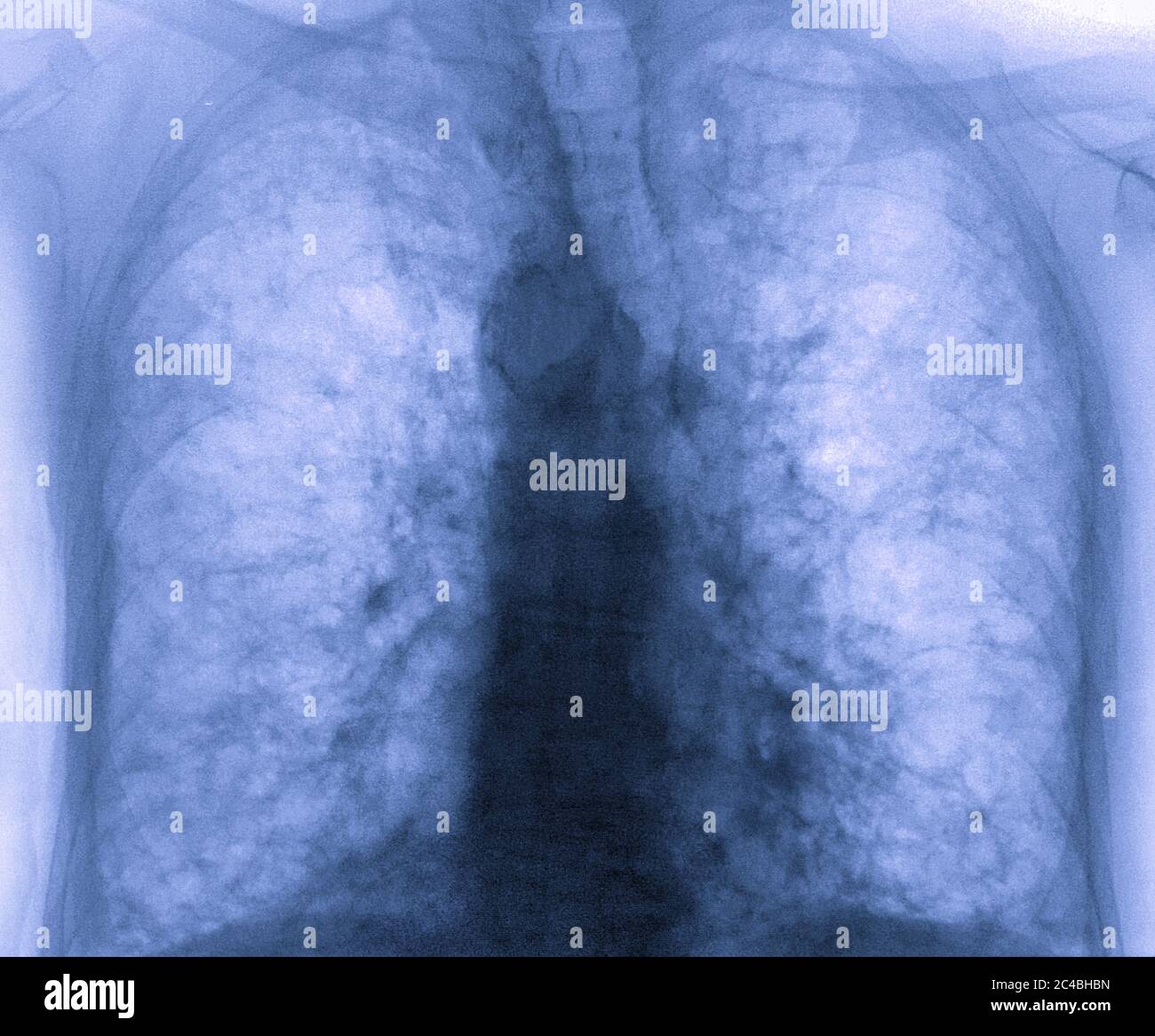 Fibrose pulmonaire (lésion des poumons caractérisée par la présence d ...