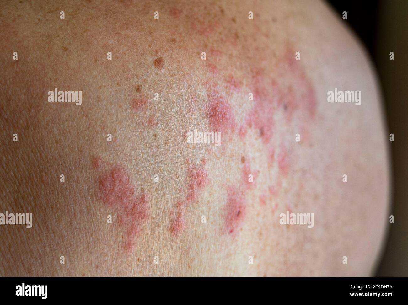 Gürtelrose aricella zoster virus -Fotos und -Bildmaterial in hoher ...