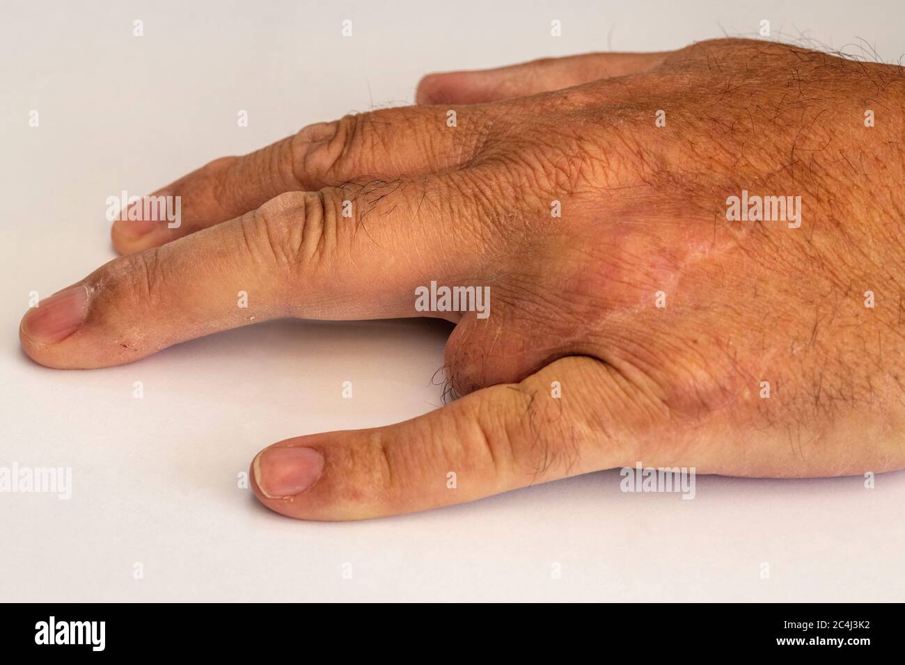 Ringfinger entfernt -Fotos und -Bildmaterial in hoher Auflösung – Alamy