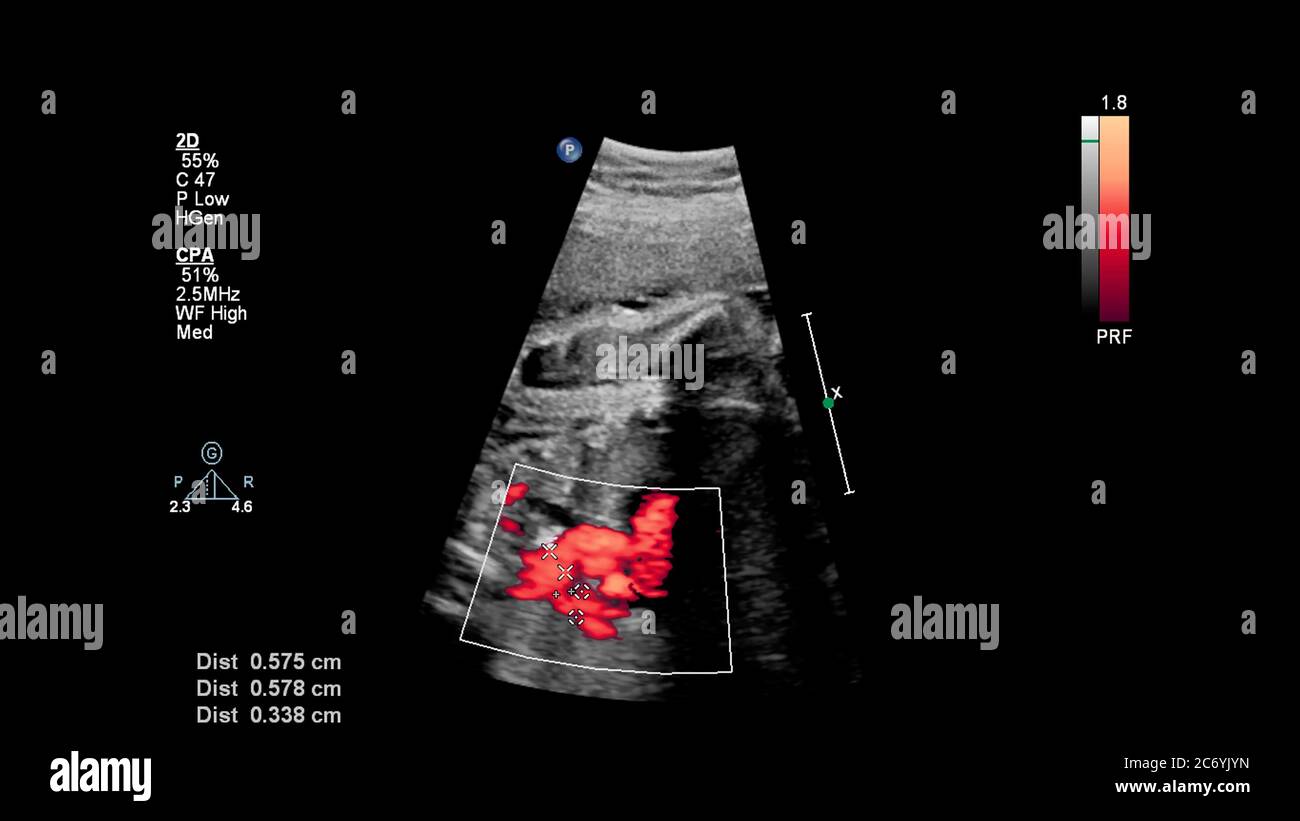 Echokardiographie ultraschall -Fotos und -Bildmaterial in hoher ...