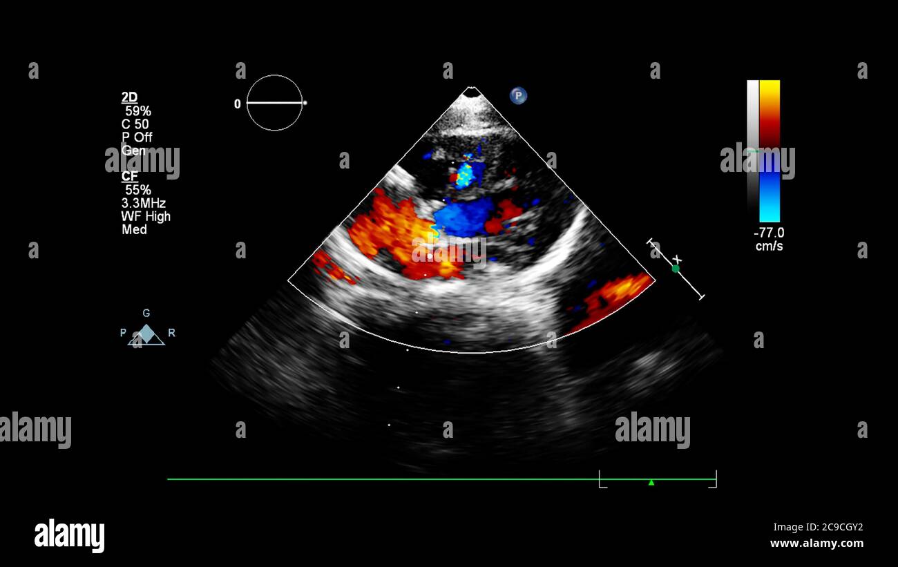 Estenosis pulmonar -Fotos und -Bildmaterial in hoher Auflösung – Alamy