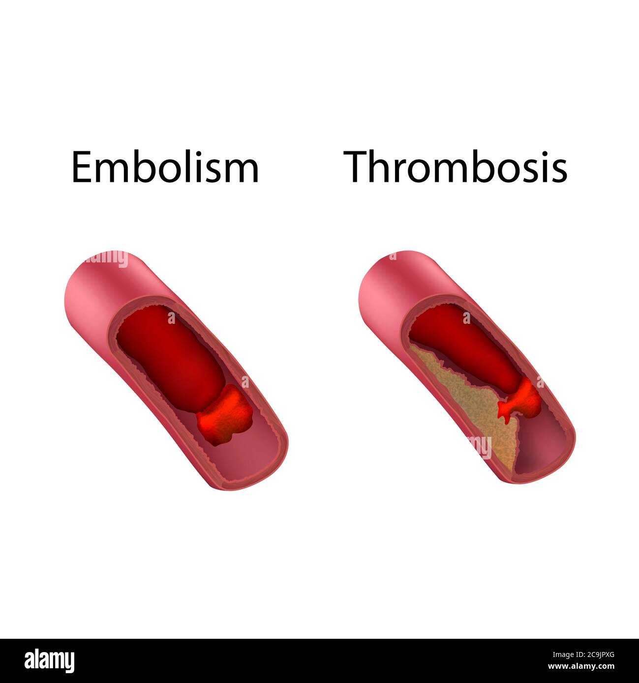 Embolie und Thrombose, Vergleich, Illustration Stockfotografie - Alamy